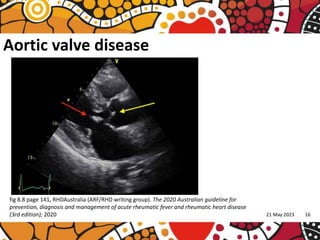 rhd_diagnosis_management.pptx