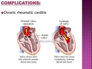 Rheumatic heart disease | PPTX