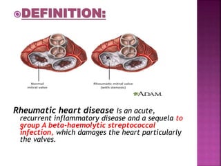 Rheumatic heart disease | PPTX