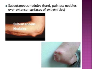 Rheumatic heart disease | PPTX