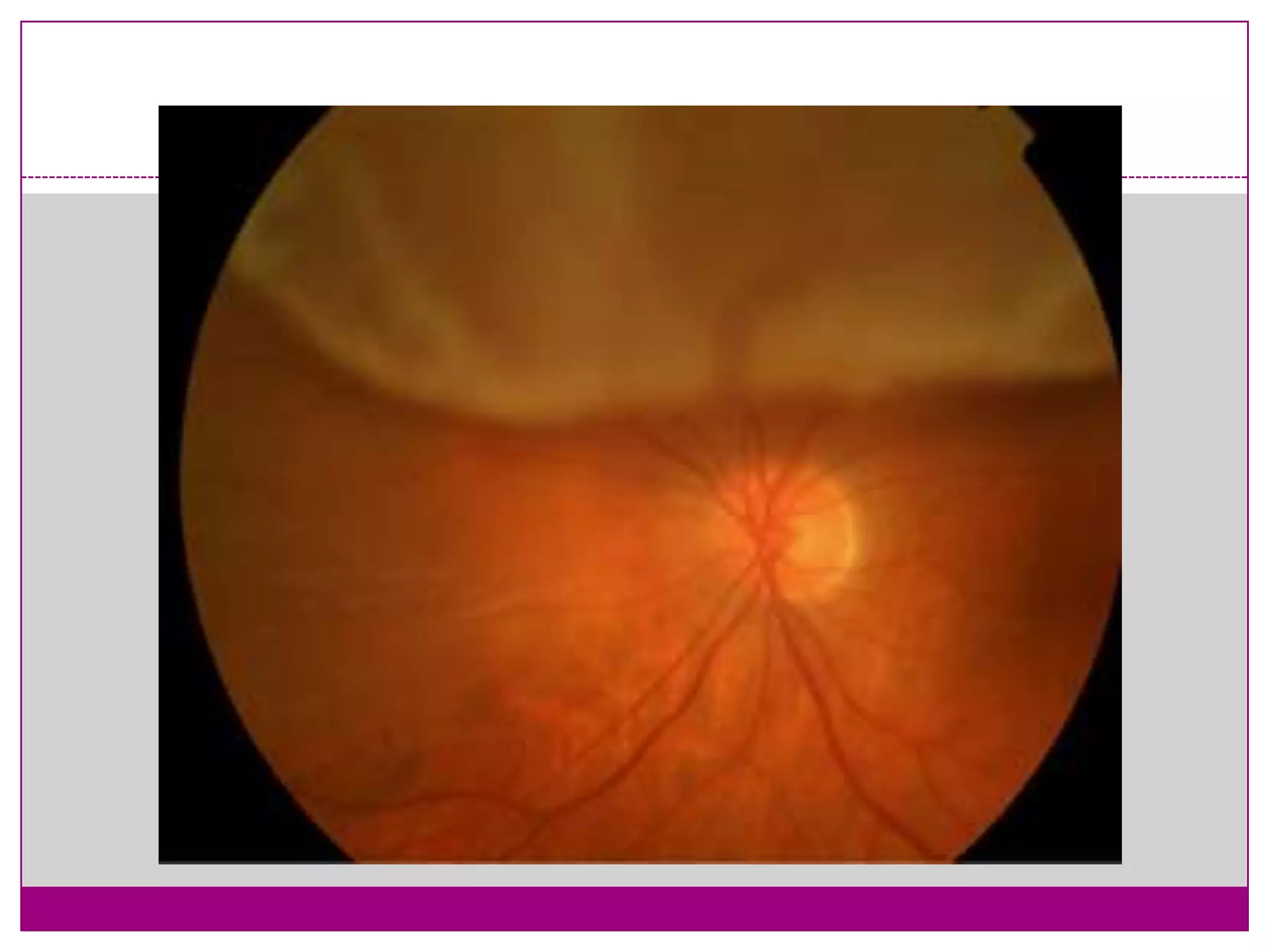 Rhegmatogenous retinal detachment | PPTX