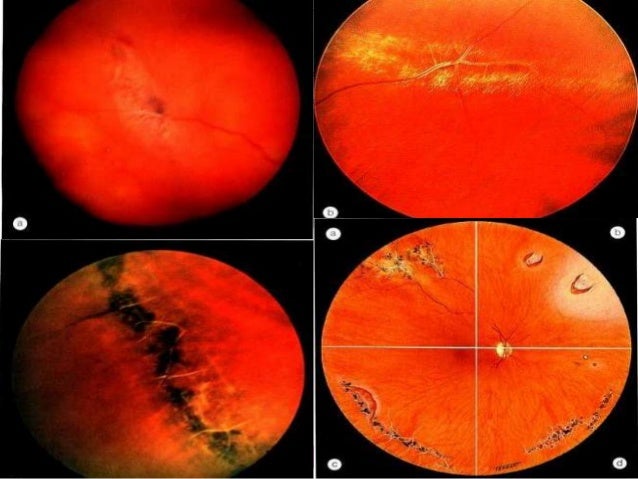 Rhegmatogenous retinal detachment