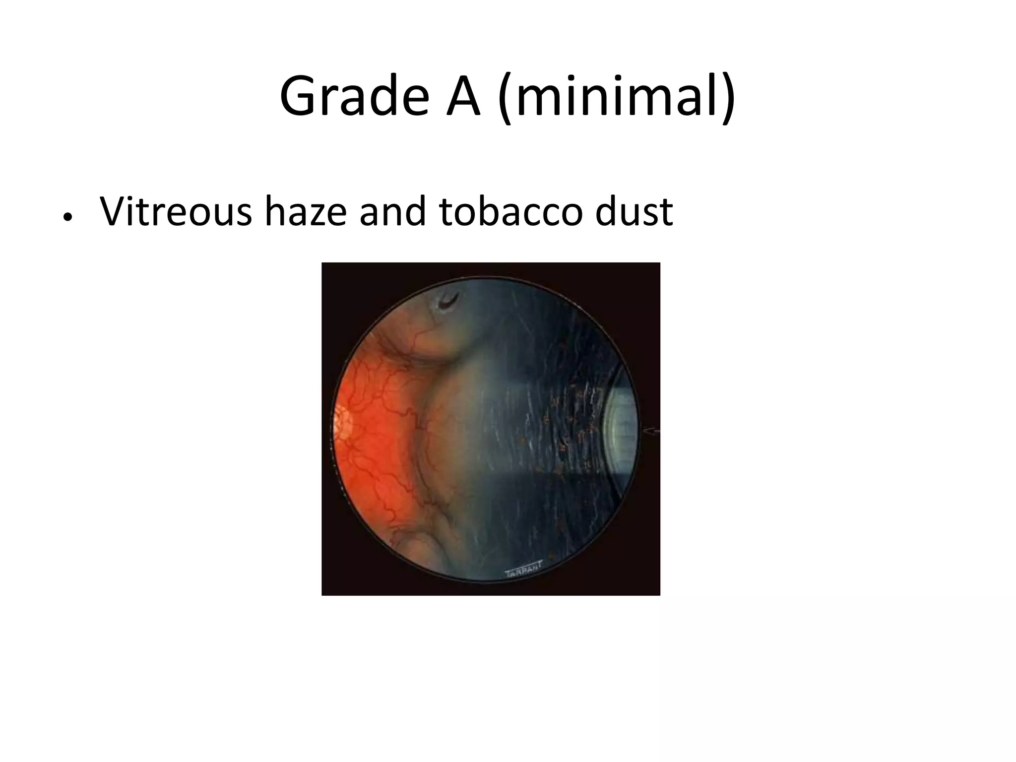 Rhegmatogenous retinal detachment (rrd) | PPTX