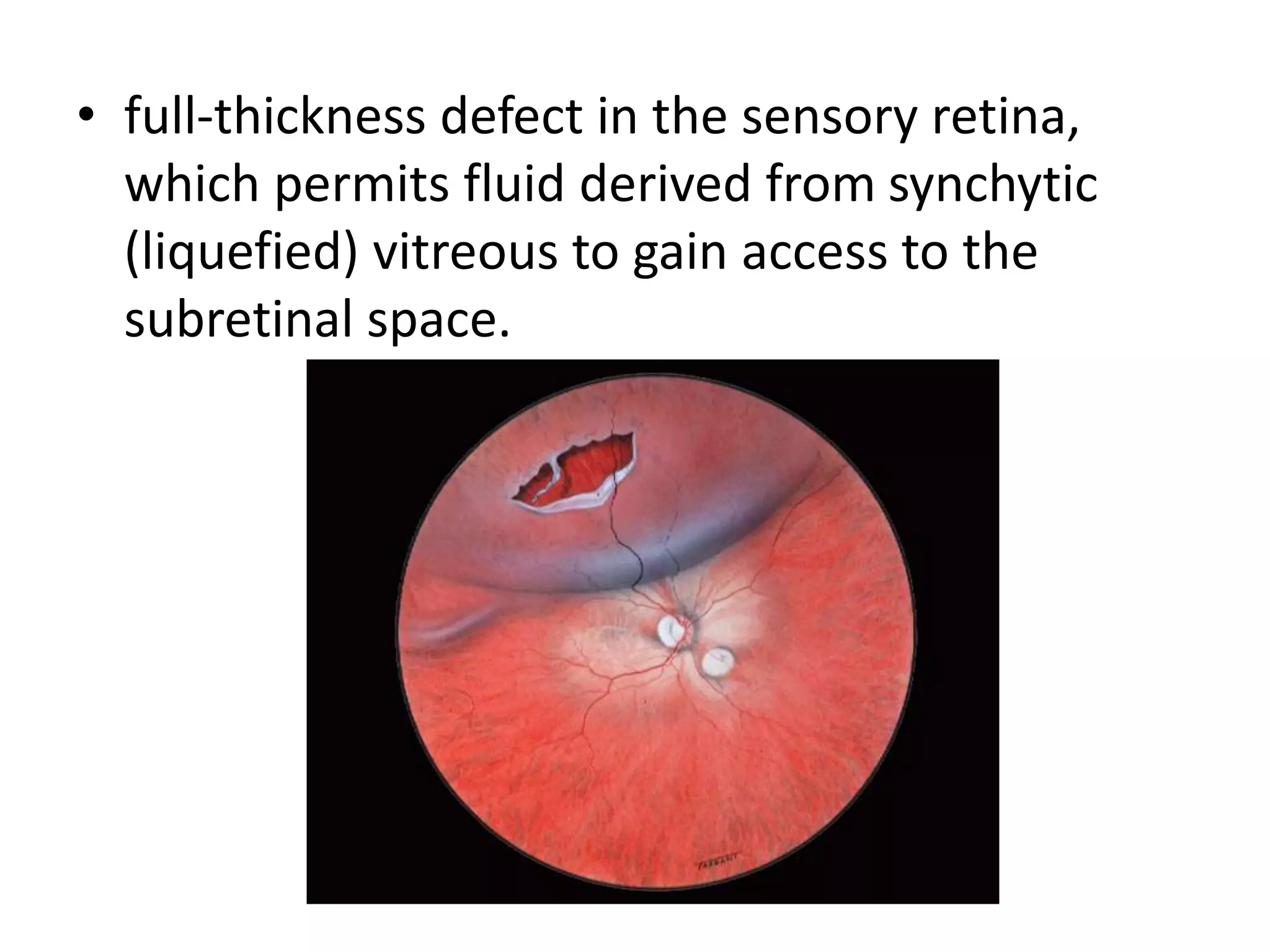 Rhegmatogenous retinal detachment (rrd) | PPTX