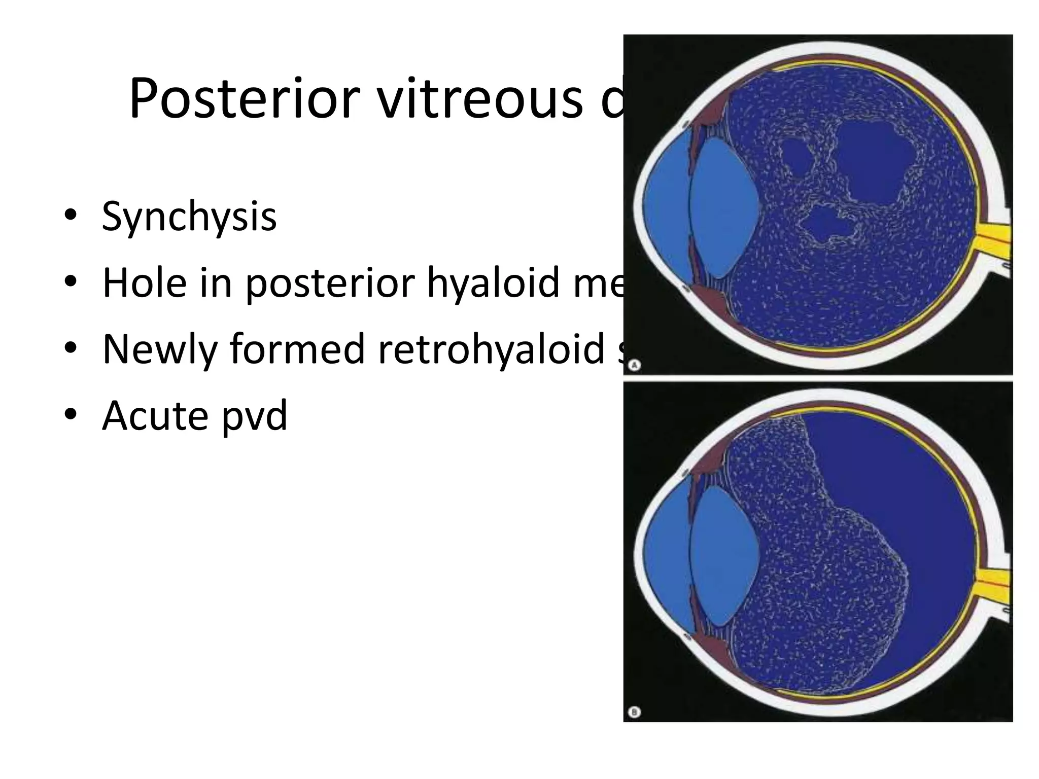 Rhegmatogenous retinal detachment (rrd) | PPTX