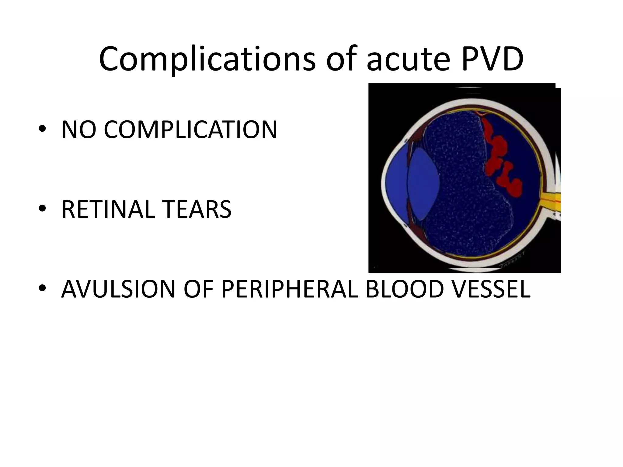 Rhegmatogenous retinal detachment (rrd) | PPTX