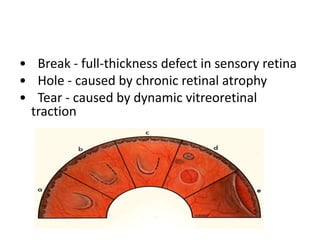 Rhegmatogenous retinal detachment (rrd) | PPTX
