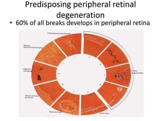 Rhegmatogenous retinal detachment (rrd) | PPTX
