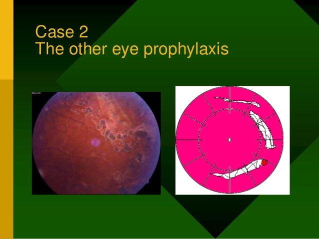 Rhegmatogenous retinal detachments