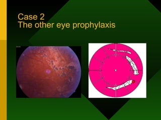 Rhegmatogenous retinal detachments | PPT
