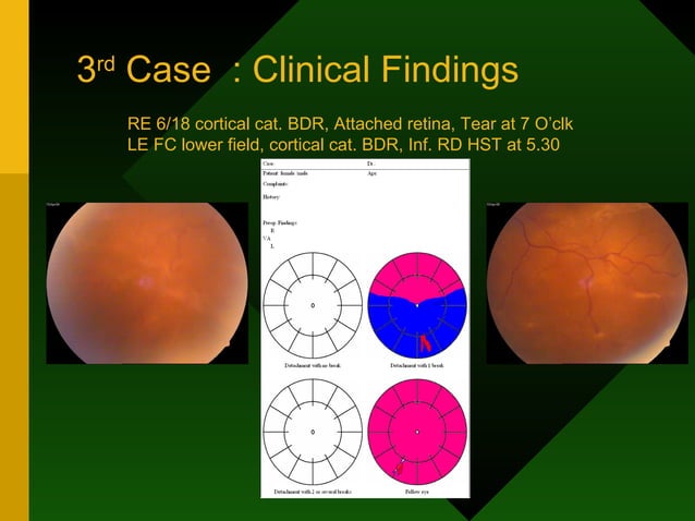 Rhegmatogenous retinal detachments | PPT