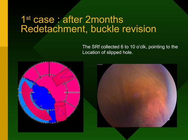 Rhegmatogenous retinal detachments | PPT