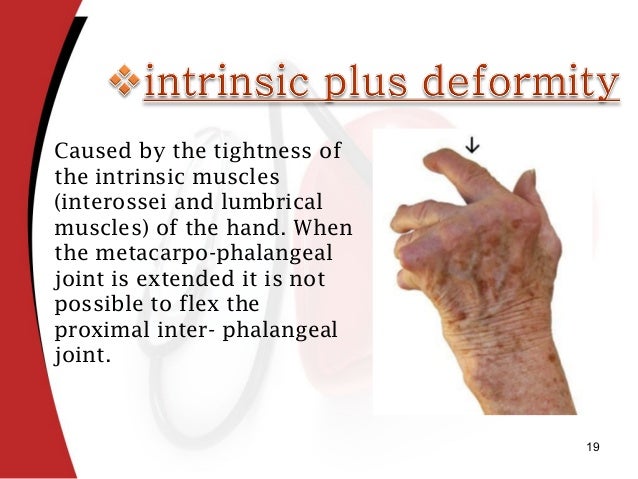 Rhemathoid Arthritis Ra