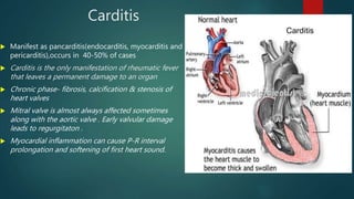 Rhematic fever | PPTX | Heart and Cardiovascular Diseases | Diseases ...