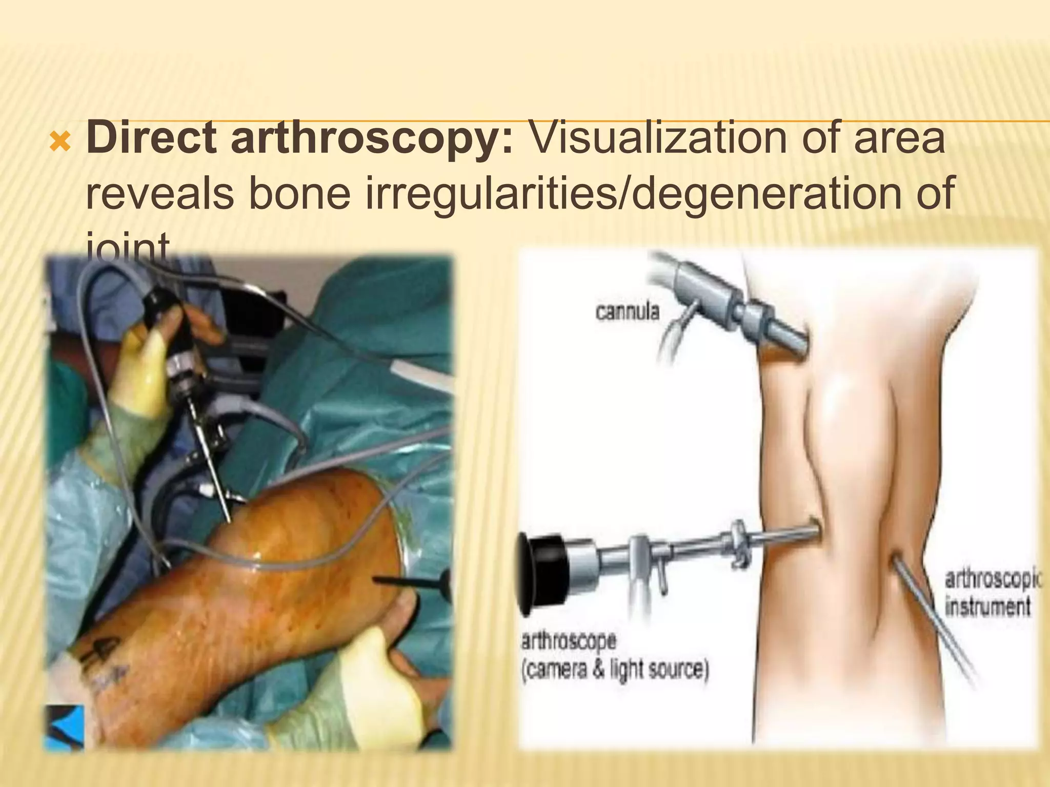 Rhematoid Arthritis Uploaded Ppt