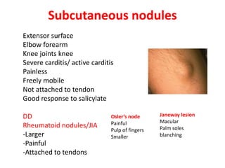Subcutaneous Nodules Rheumatic Fever
