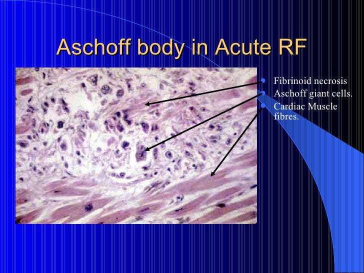 RHEUMATIC HEART DISEASE BY DR BASHIR AHMED DAR ASSOCIATE PROFESSOR ME…