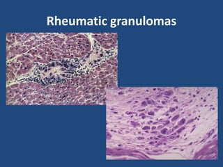 Rheumatic diseases pathology anatomy disease | PPTX