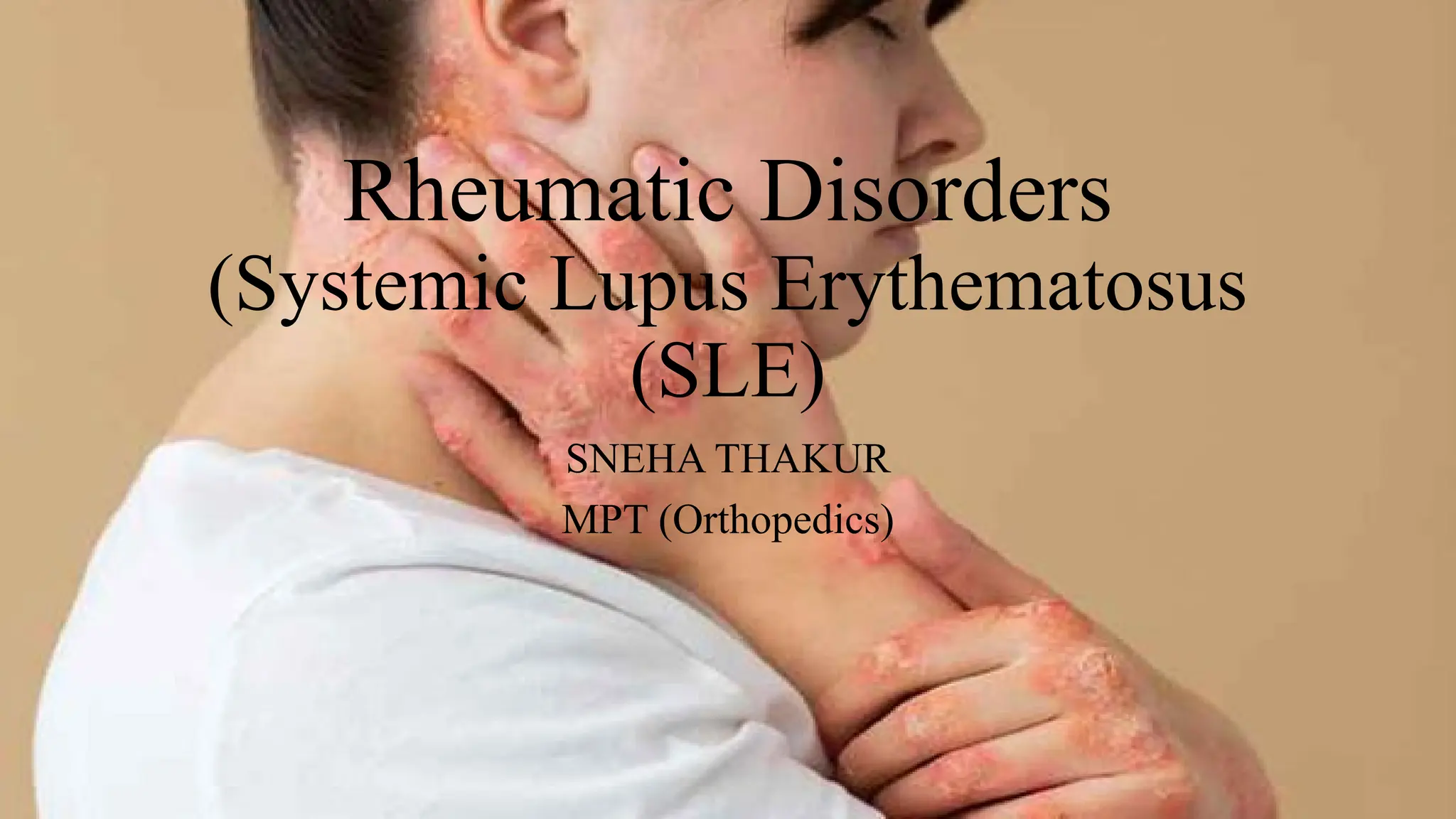 Rheumatic Disorders (Systemic Lupus Erythematosus (SLE) with physiotherapy management | PPT