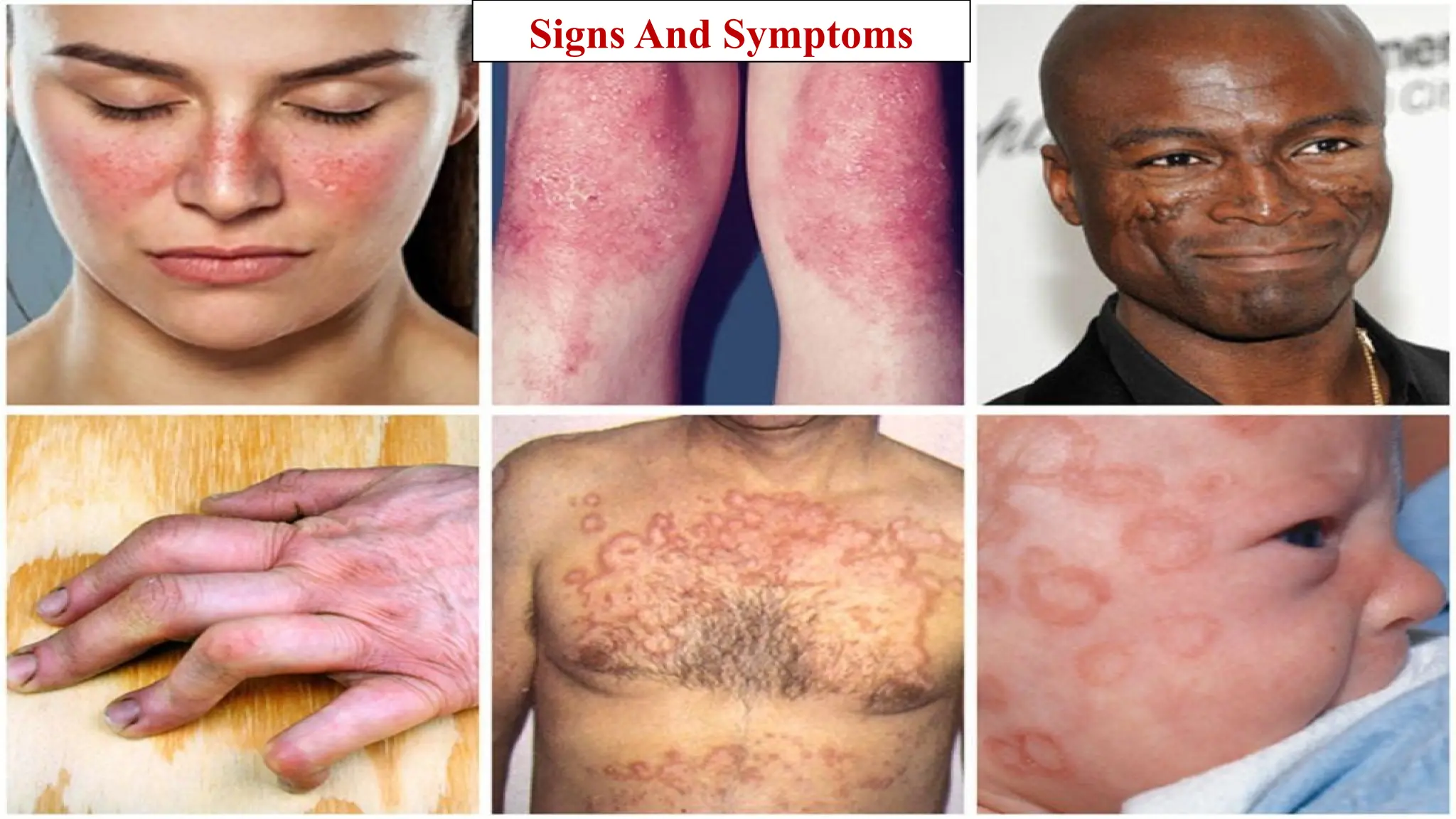 Rheumatic Disorders (Systemic Lupus Erythematosus (SLE) with ...