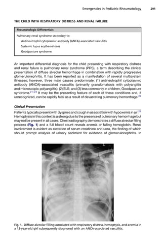 Emergencies in Pediatric Rheumatology | PDF