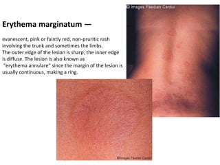 Rheumatic fever | PPTX