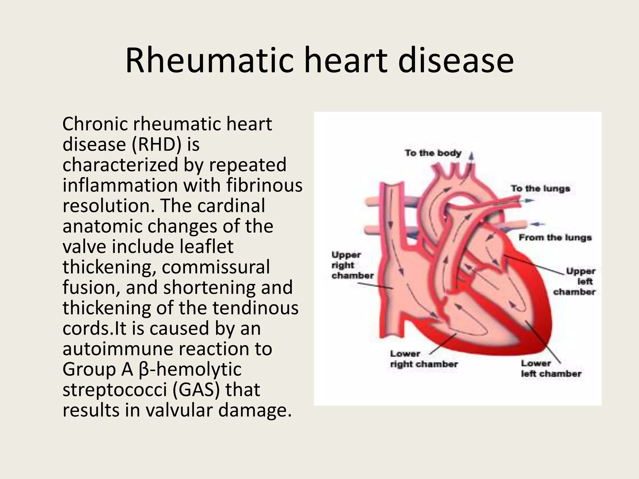 Rheumatic Fever | PPTX