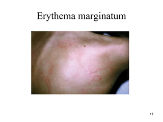 Erythema Marginatum Rheumatic Fever