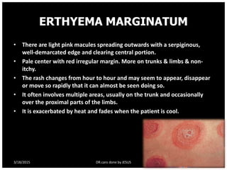 Rheumatic fever | PPTX
