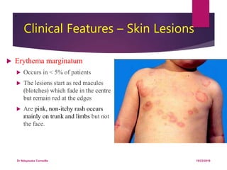 RHEUMATIC FEVER | PPT