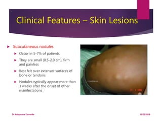 RHEUMATIC FEVER | PPT