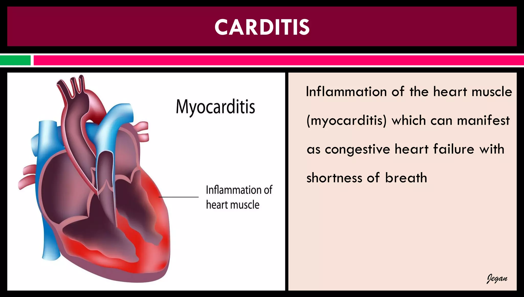 Pathophysiology of Rheumatic fever | PDF