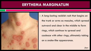 Erythema Marginatum Rheumatic Fever