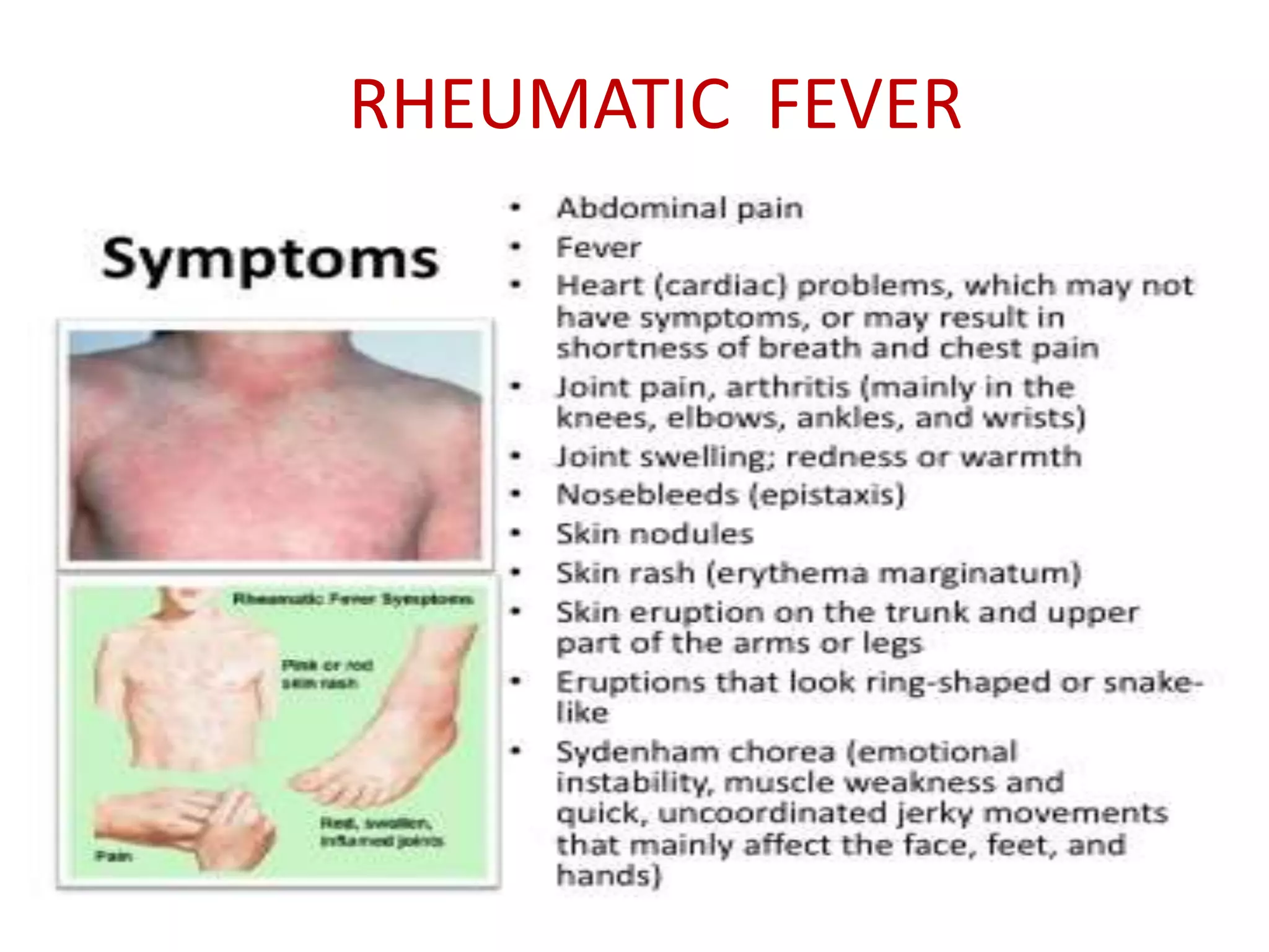 Rheumatic fever | PPT