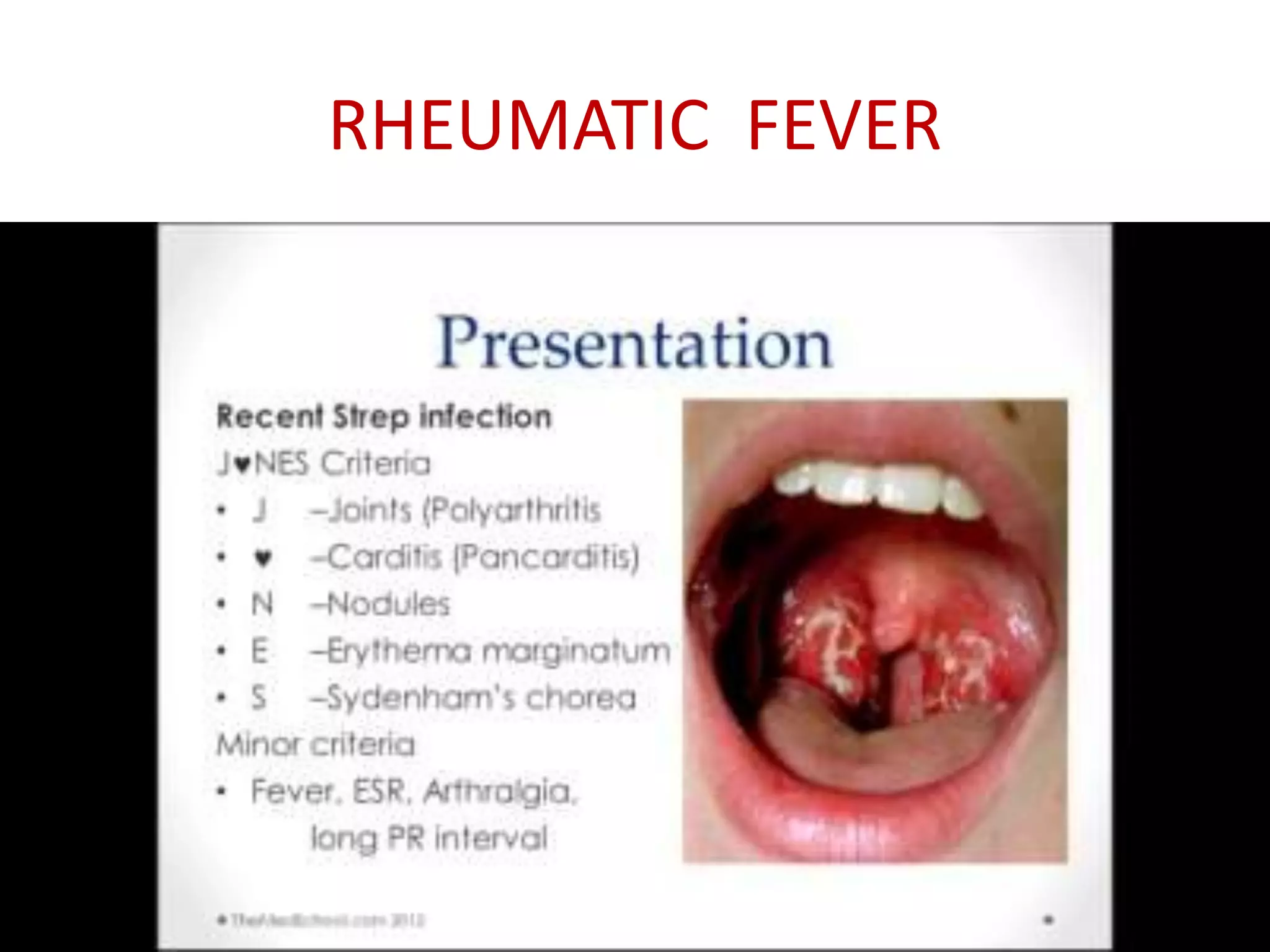 Rheumatic fever | PPT