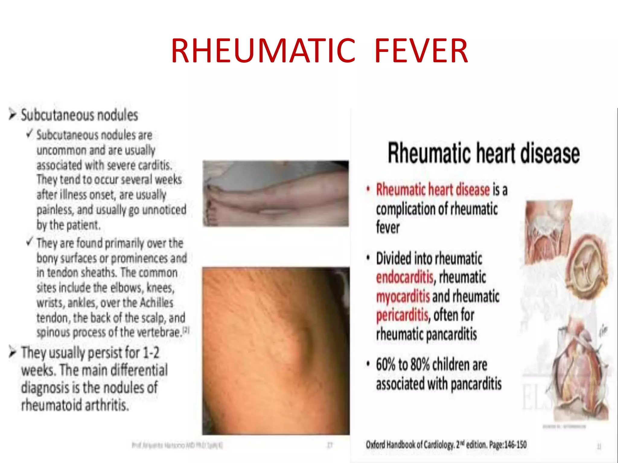 Rheumatic fever | PPT