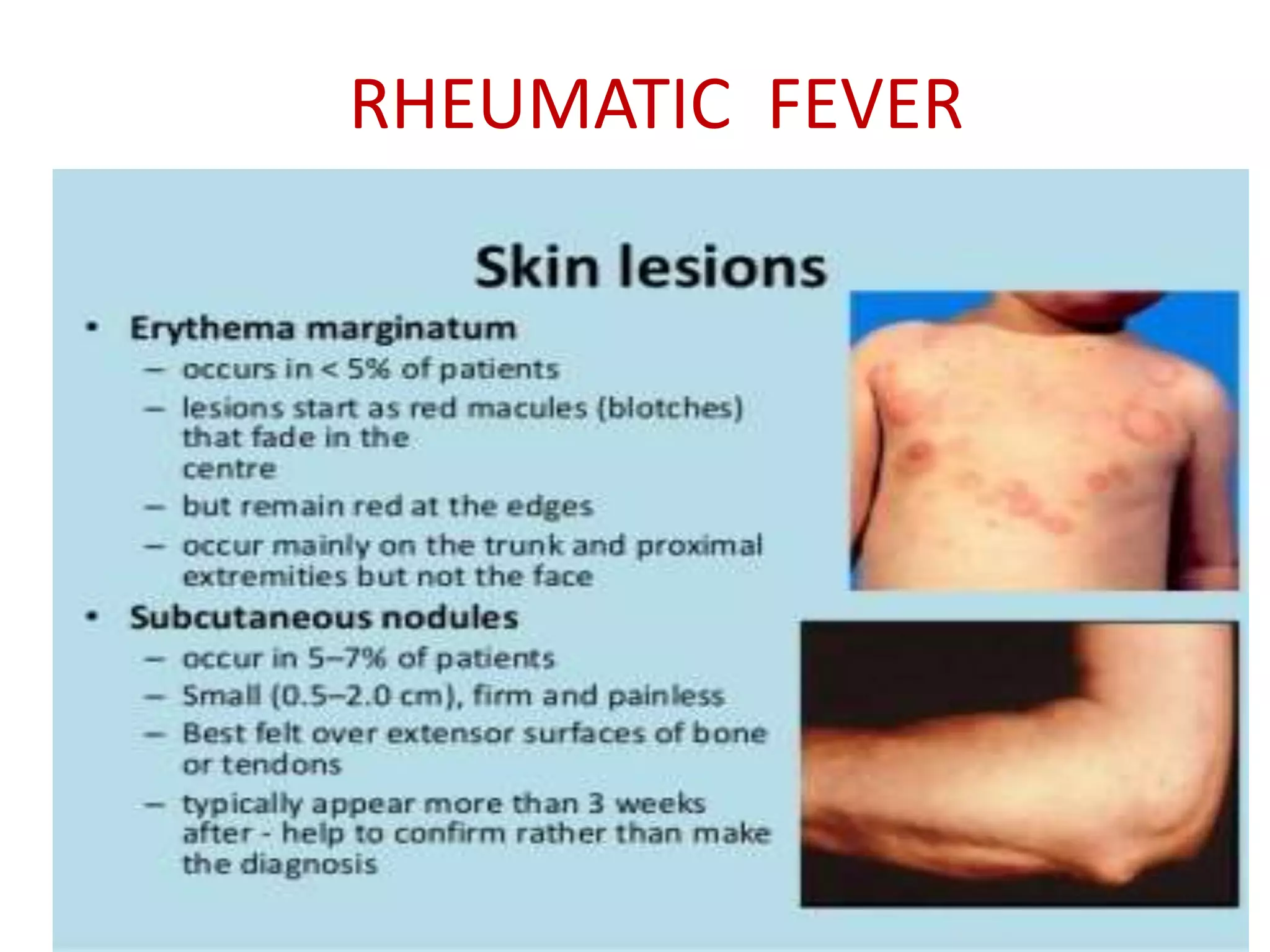 Rheumatic fever | PPT
