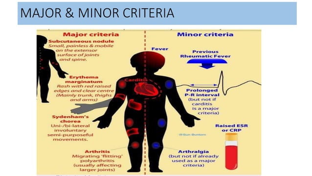 RHEUMATIC FEVER | PPT