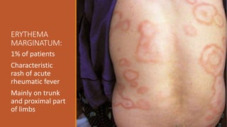 RHEUMATIC FEVER.pptx