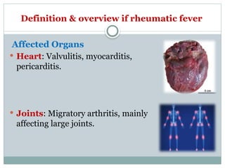 Rheumatic fever rheumatic fever....pptx
