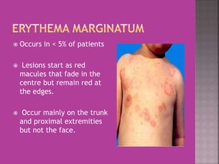 Rheumatic fever 1.pptx
