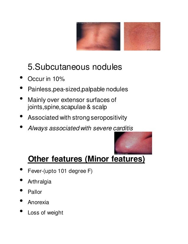 Rheumatic fever in pediatrics