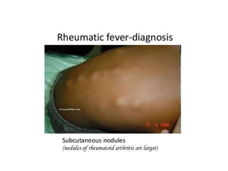 Subcutaneous Nodules Rheumatic Fever