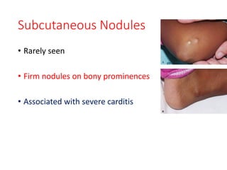 Subcutaneous Nodules Rheumatic Fever