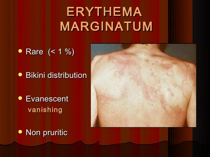 Rheumatic fever clinical features and diagnosis