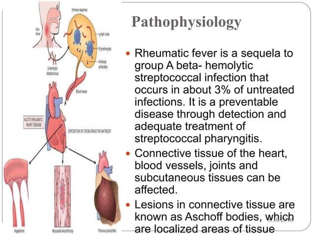 Rheumatic fever | PPTX