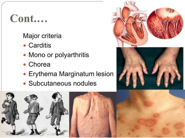Rheumatic fever | PPT