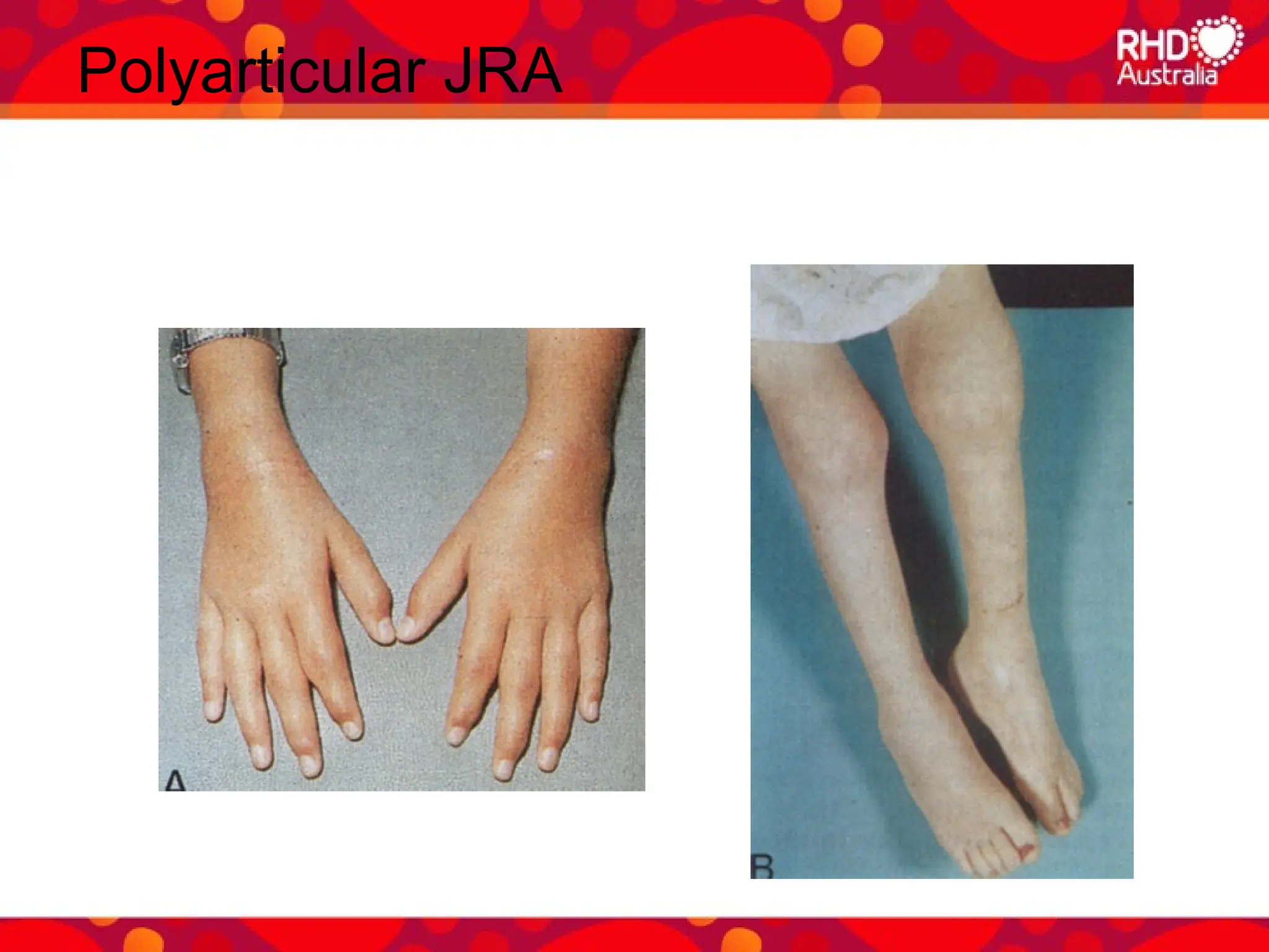 rheumatic fever +Juvenile idiopathic arthritis .pptx