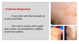 Erythema Marginatum Rheumatic Fever