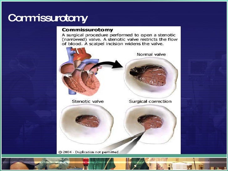 Rheumatic Heart Disease